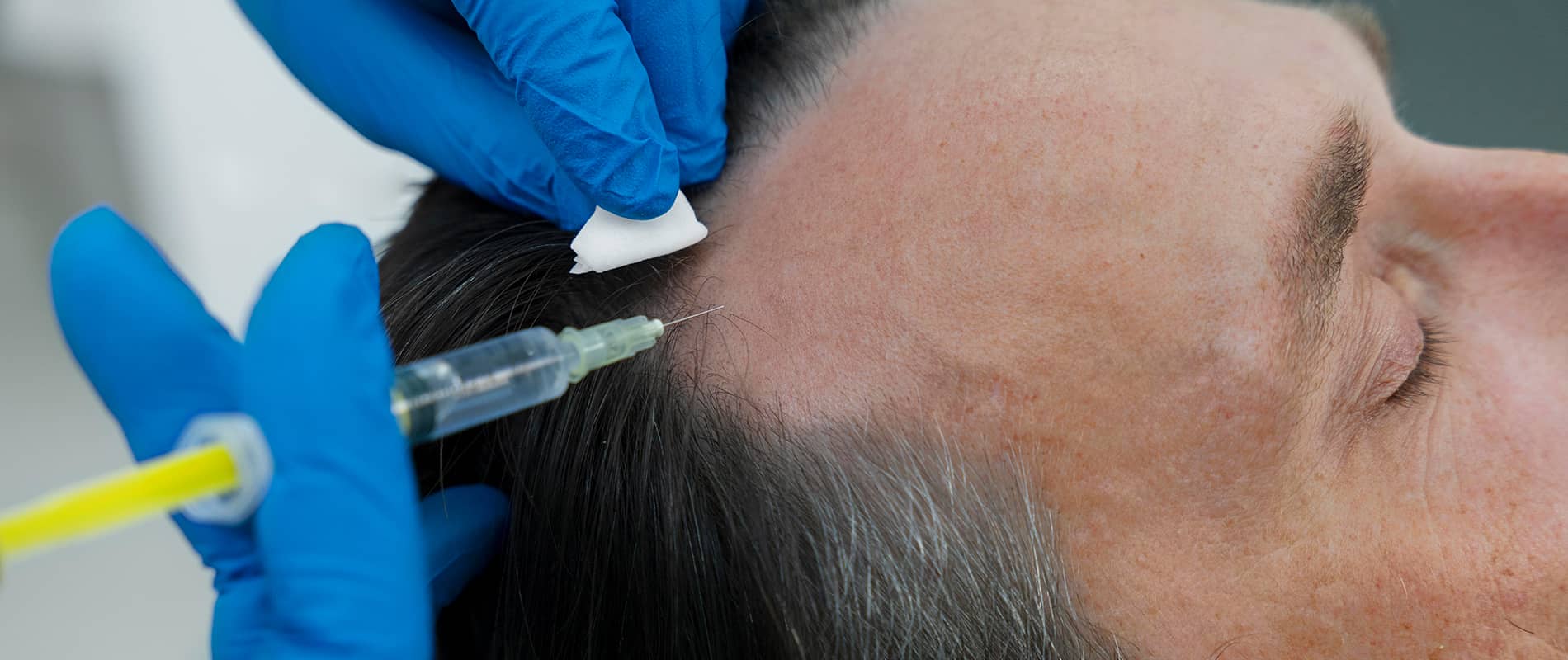 Vampire Hair Restoration - Madison Wellness & Aesthetic Center
