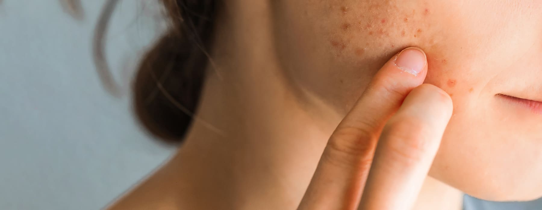 Does dermaplaning help with acne | Madison Wellness & Aesthetic Center